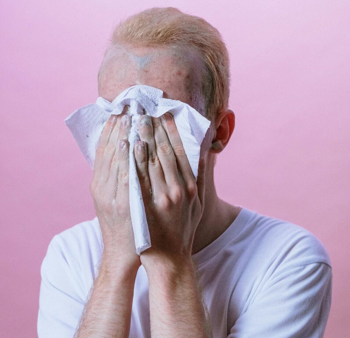 What is Good for Acne? 15 Natural Acne Solutions - Natural Life Tricks