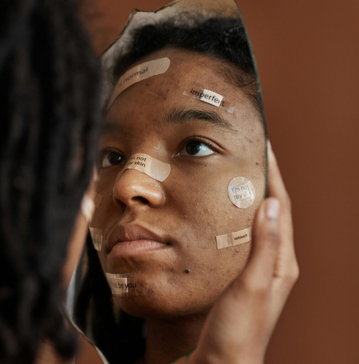 What is Good for Acne? 15 Natural Acne Solutions - Natural Life Tricks